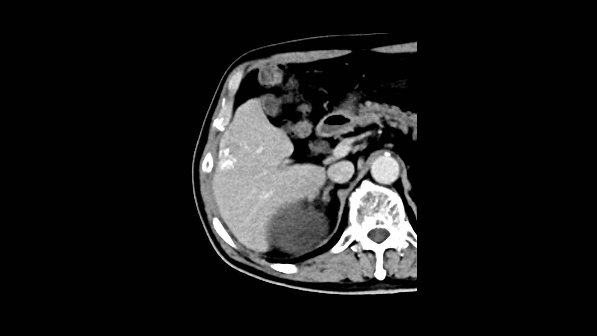 Recurrent Hepatocellular Carcinoma after TACE in a Patient with Renal ...