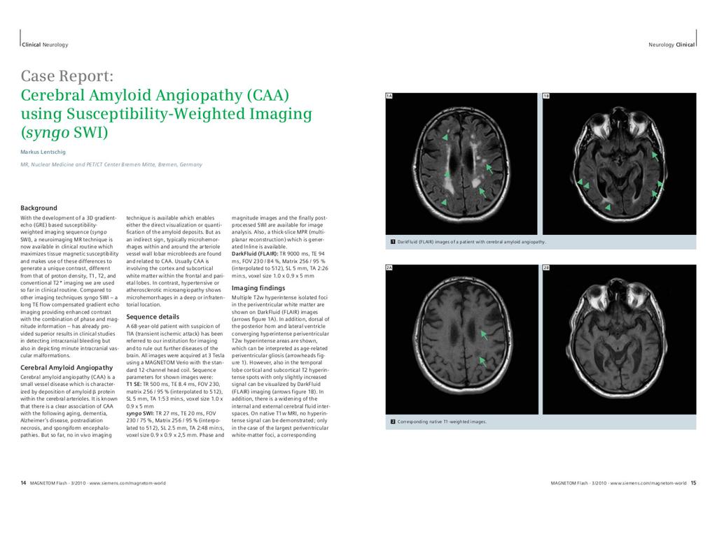 Imaging of Cerebral Amyloid Angiopathy (CAA) using syngo SWI