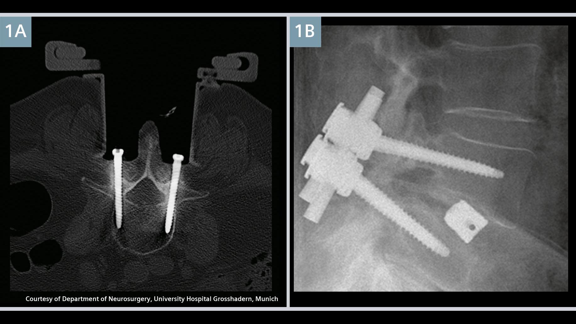 Intraoperative CT – Better Views for Neurosurgeons