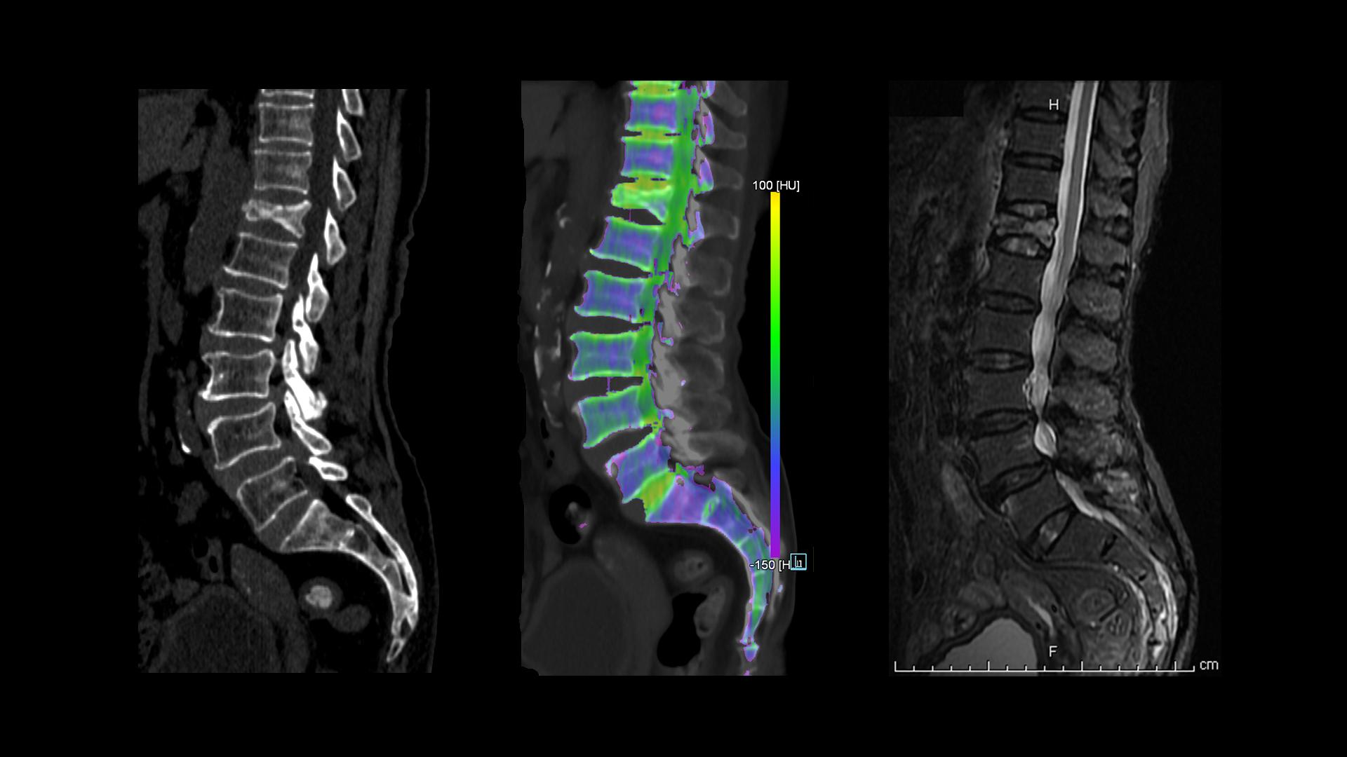 Vertebral Compression Fracture – Fresh or Old? - Siemens Healthineers