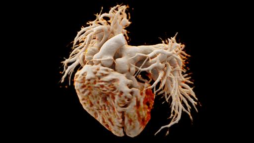 Transposition of the Great Arteries with Multiple Interventricular ...