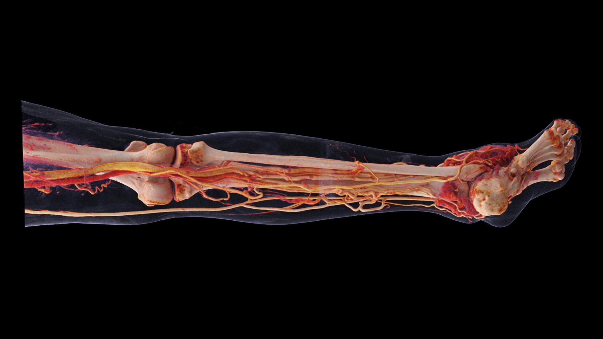 Giant Cell Tumor in Tendon Sheath of the Right Ankle - Siemens ...