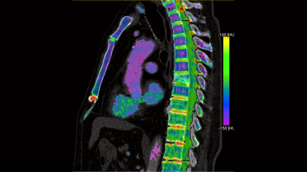 Diagnosis of Bone Marrow Edema Associated with Metastases from SCLC ...