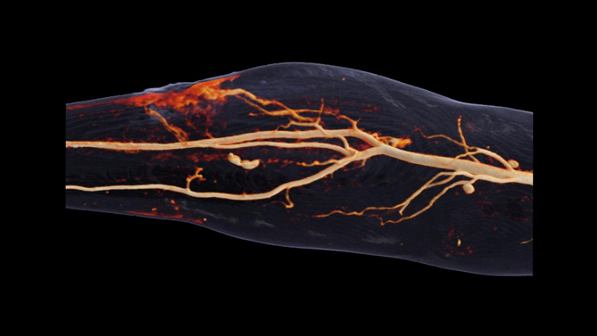 Multiple Arteriovenous Fistulas in the Left Lower Limb - Siemens ...