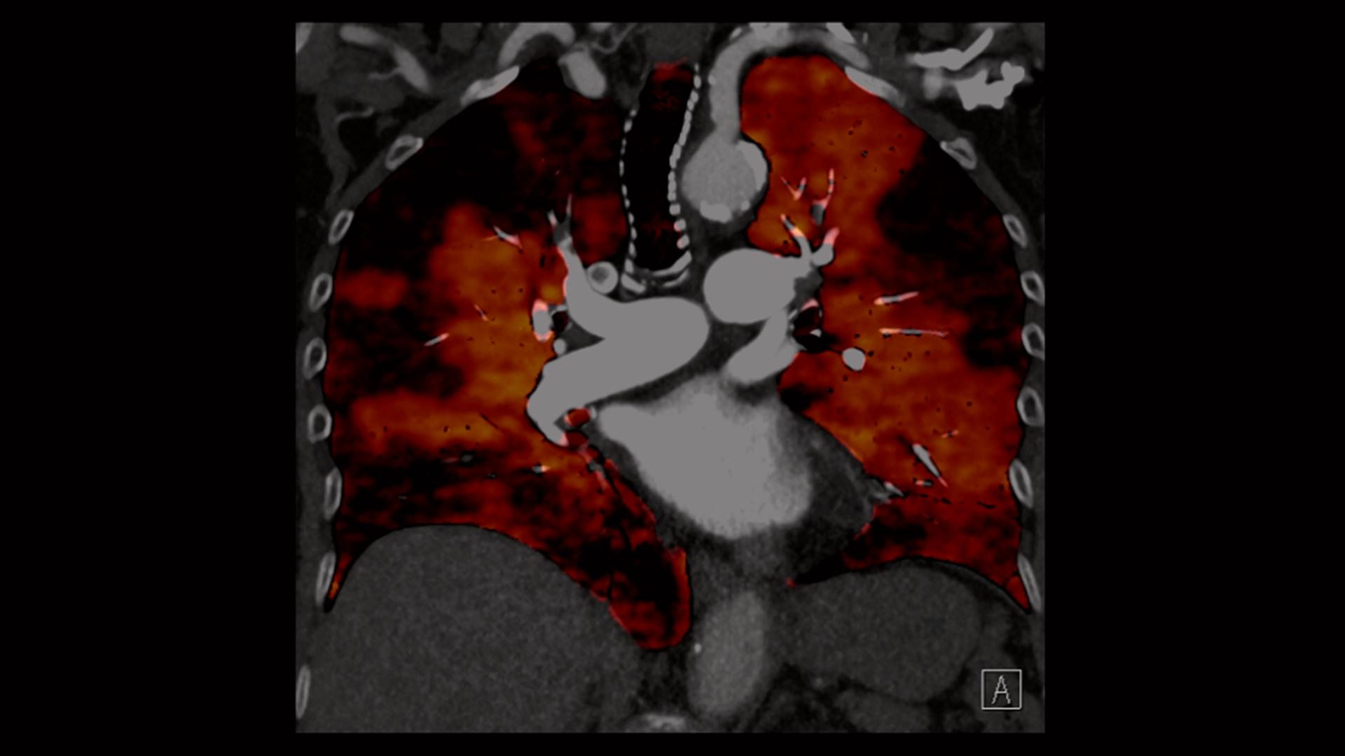 Dual Energy Perfusion Maps Reveal the Extent of Perfusion Deficits from ...