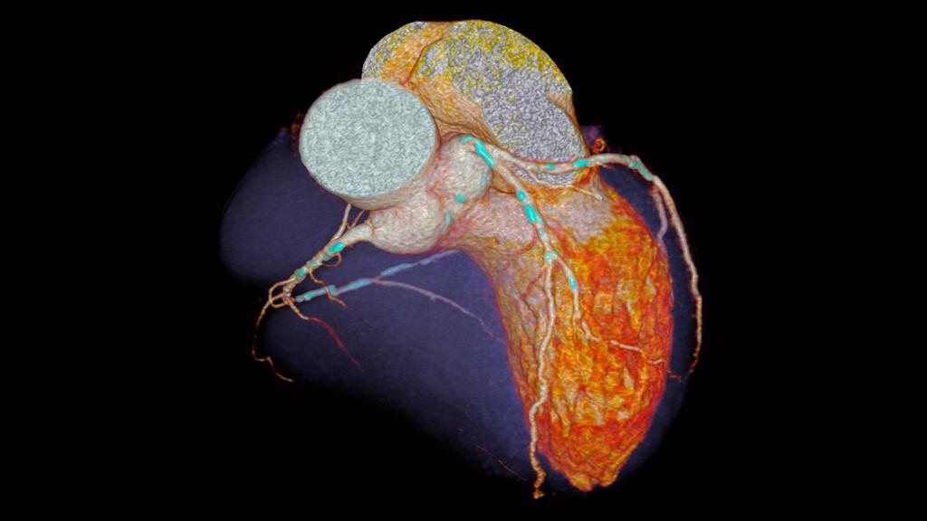 A Comprehensive Cardiac CT Examination - Siemens Healthineers USA