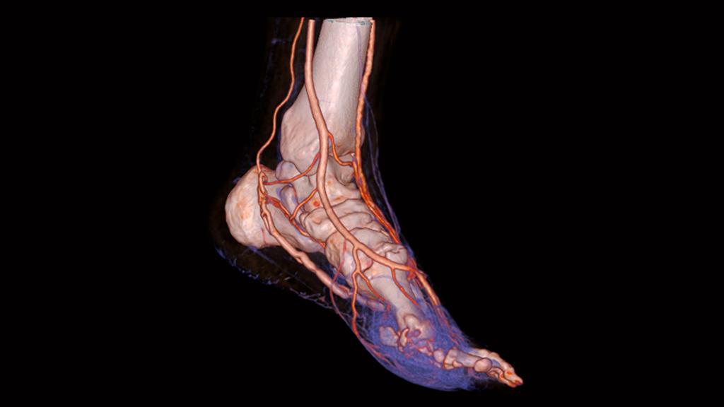 Diabetic Foot Syndrome Complicated by an Arteriovenous Fistula ...