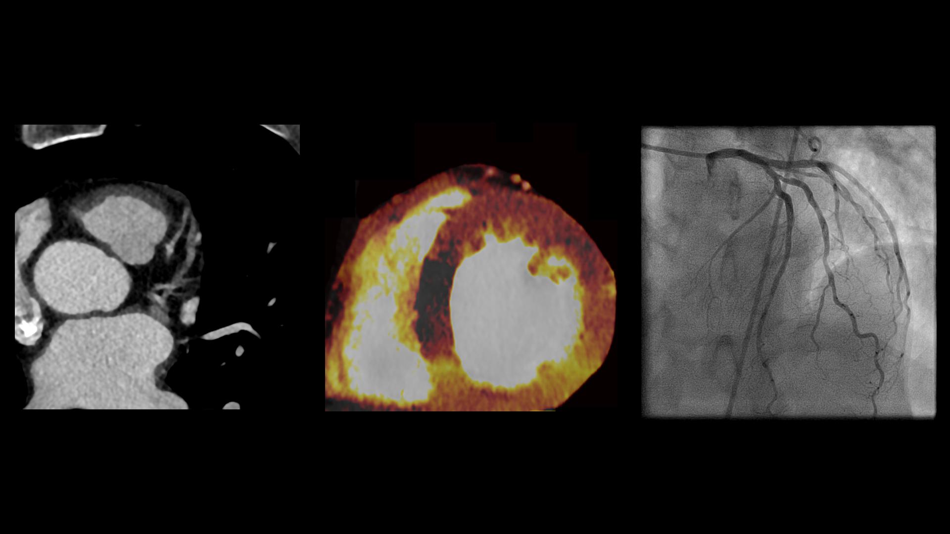 Revealing a Myocardial Perfusion Defect, unseen on MRI, using Adenosine ...