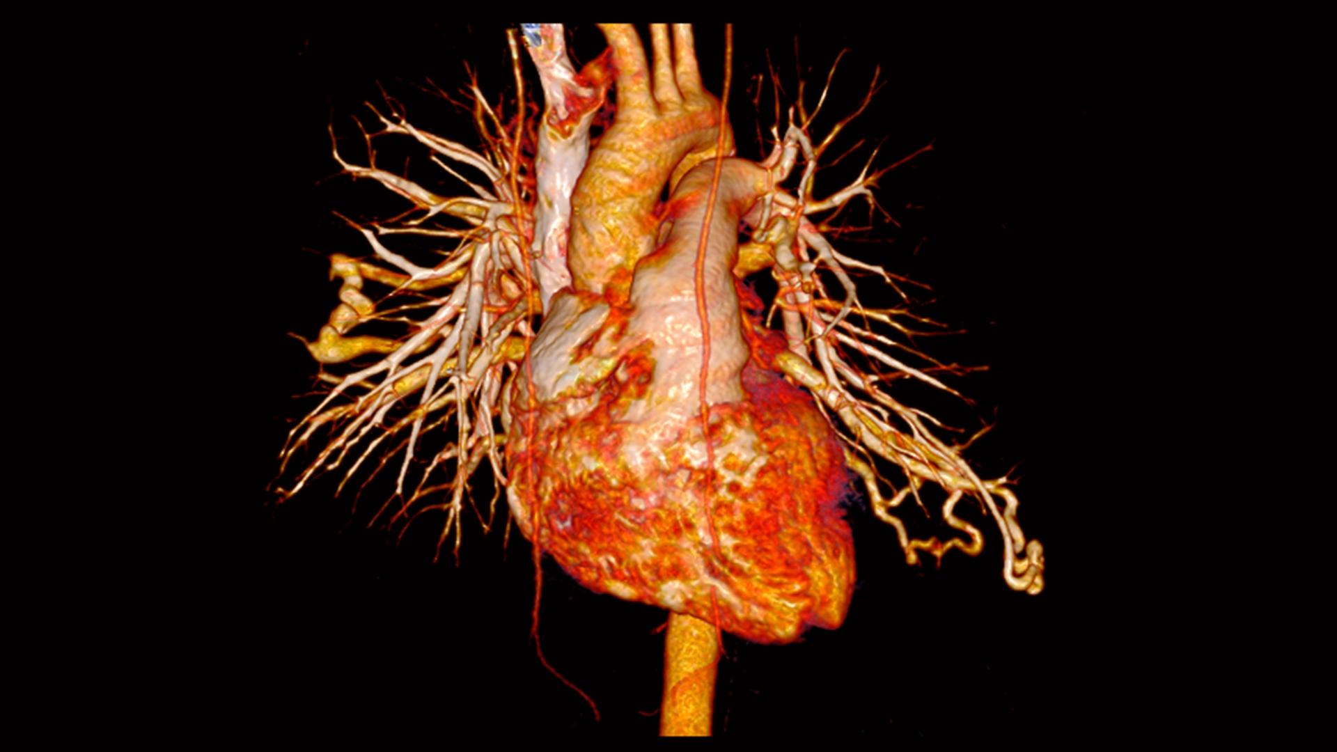 Multiple, Enlarged and Tortuous Pulmonary Vessels – a Straight Forward ...