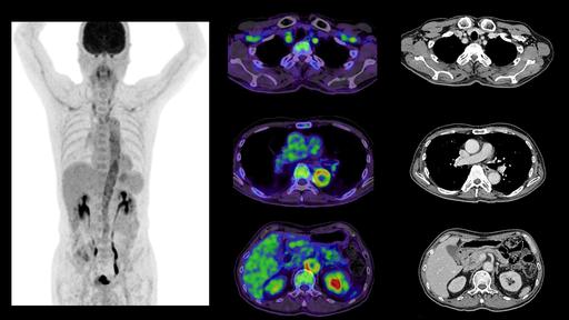 PET/CT Detection of Temporal Arteritis