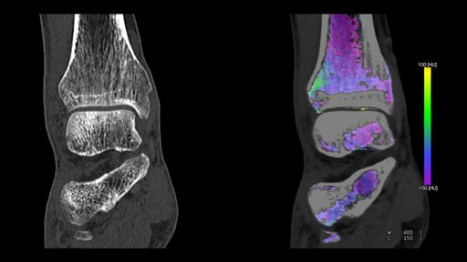 Traumatic Bone Bruise of the Right Distal Tibial Metaphysis - Siemens ...