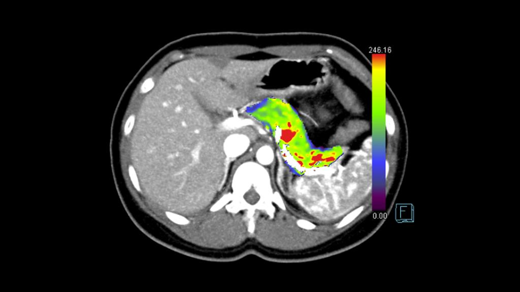 Pre-operative Detection of an Isoattenuating Pancreatic Insulinoma in ...