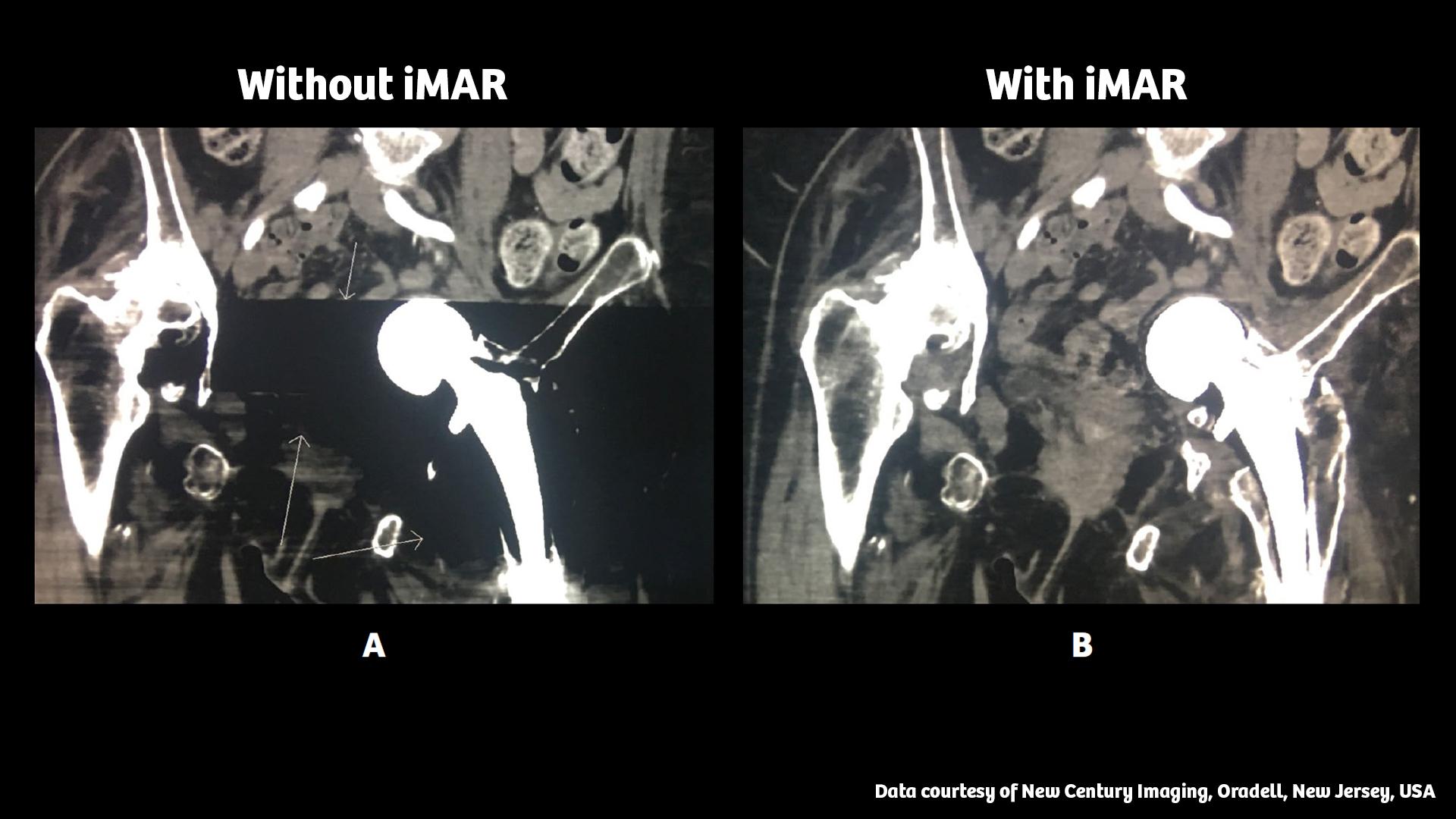 Prosthetic Metallic Artifact Reduction Siemens Healthineers
