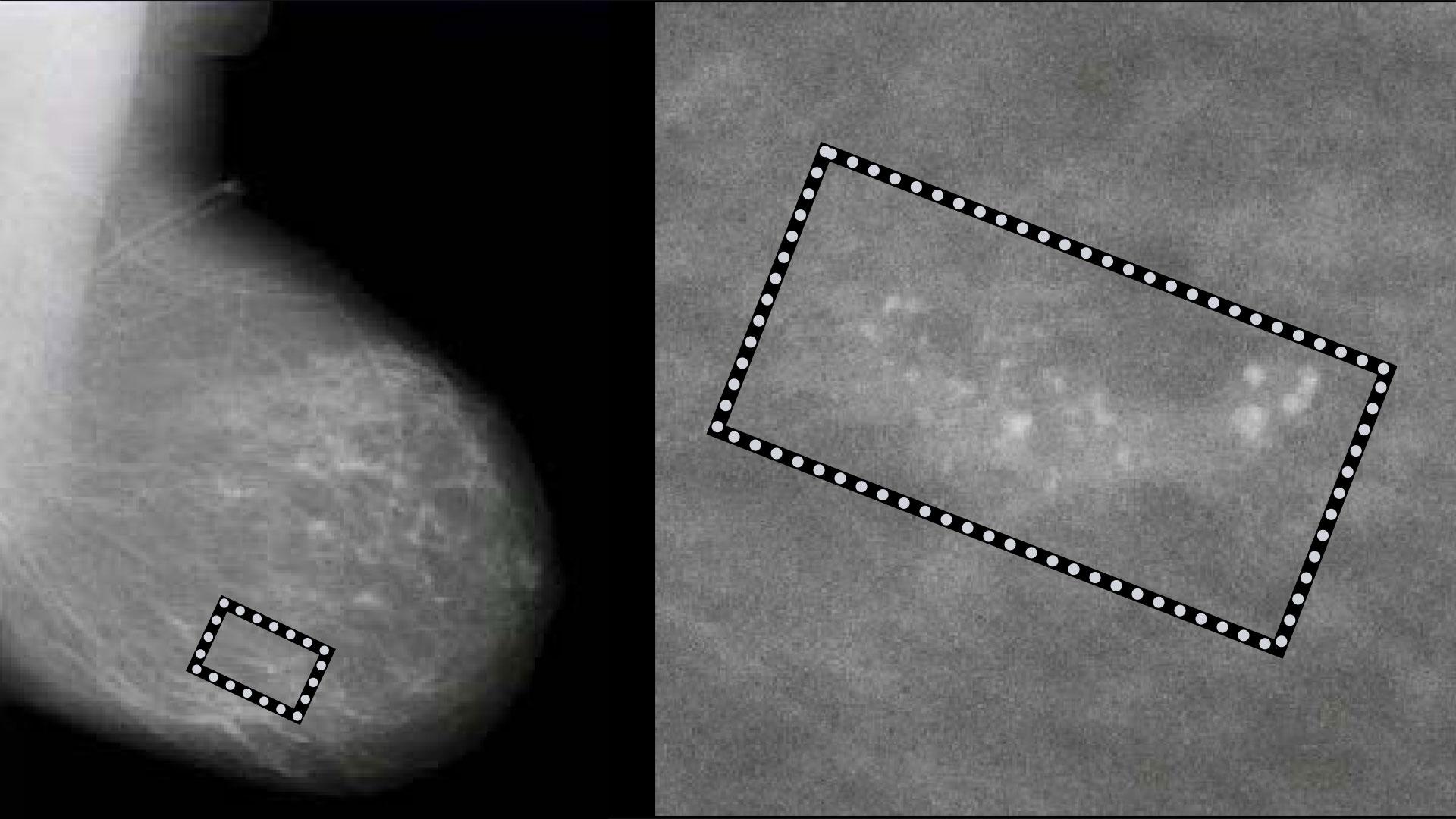 History of computer-aided detection (CAD) - Siemens Healthineers