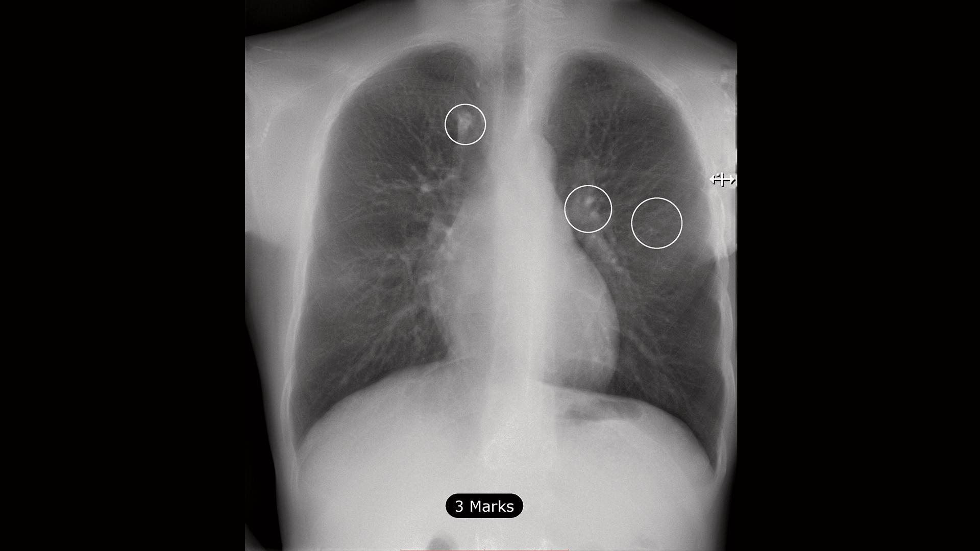 History of computer-aided detection (CAD) - Siemens Healthineers