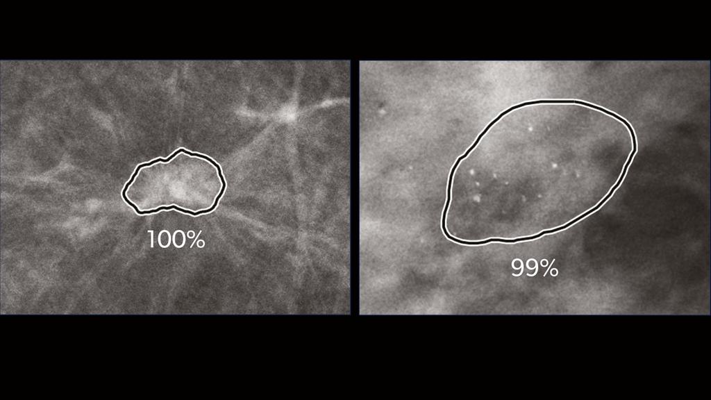 History of computer-aided detection (CAD) - Siemens Healthineers