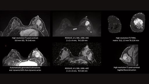 Personalizing Breast Cancer Screening