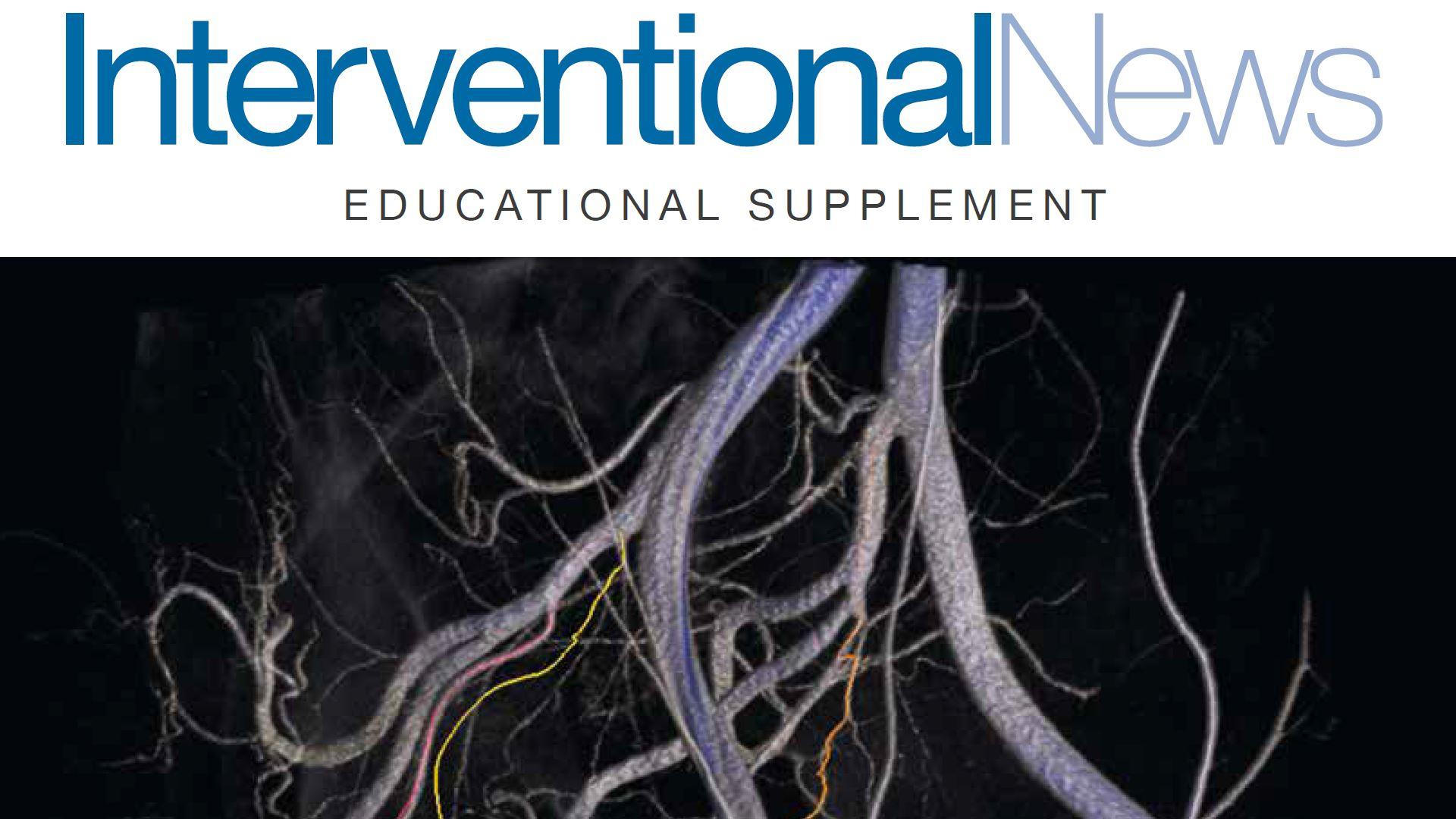 Prostate Artery Embolization - Siemens Healthineers Vietnam