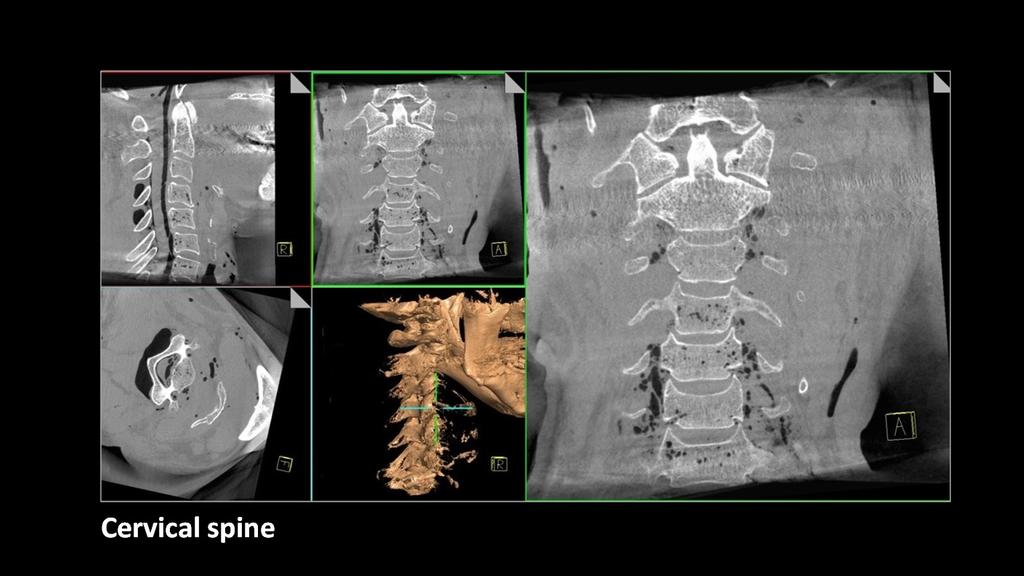 Mobile C-arm machine - Cios Spin - Siemens Healthineers Japan