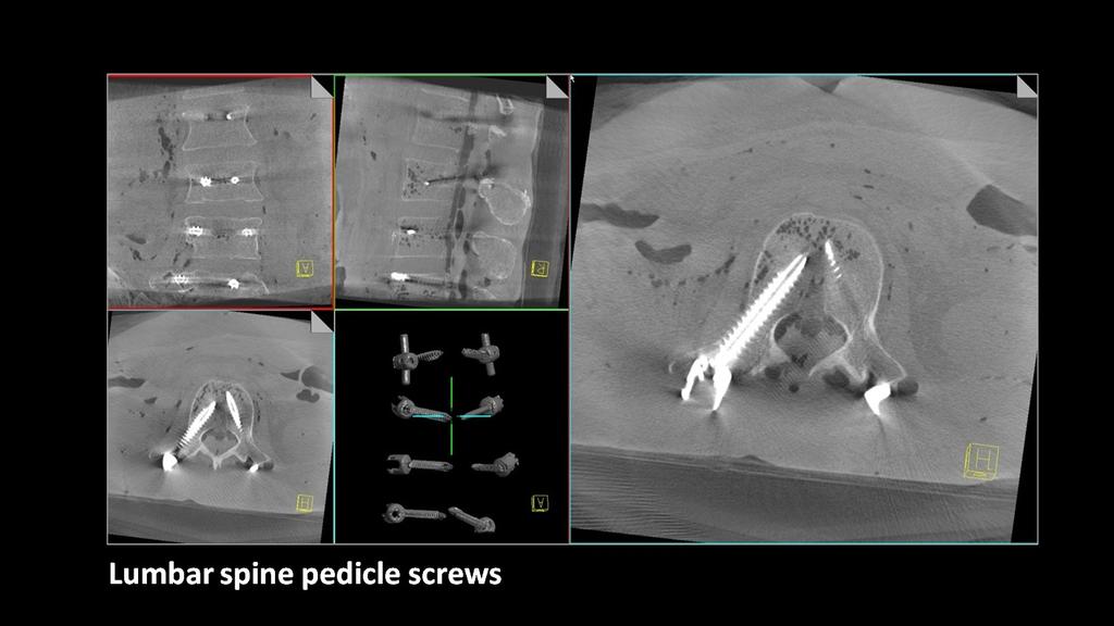 Mobile C-arm machine - Cios Spin - Siemens Healthineers Japan
