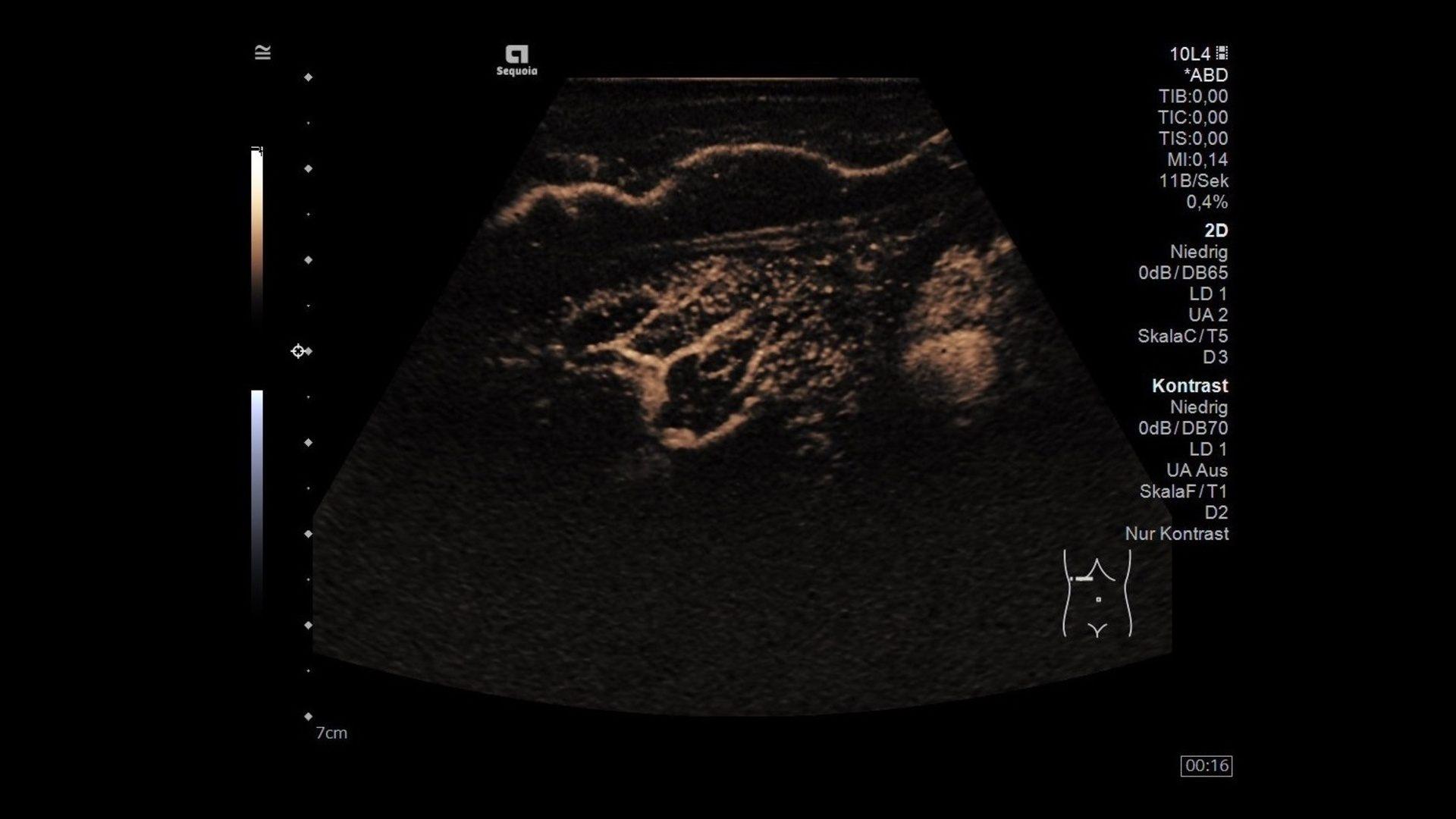 ACUSON Sequoia Ultrasound System - Siemens Healthineers USA