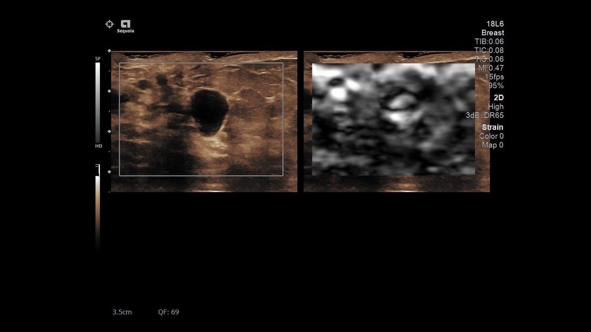 ACUSON Sequoia Ultrasound System - Siemens Healthineers USA