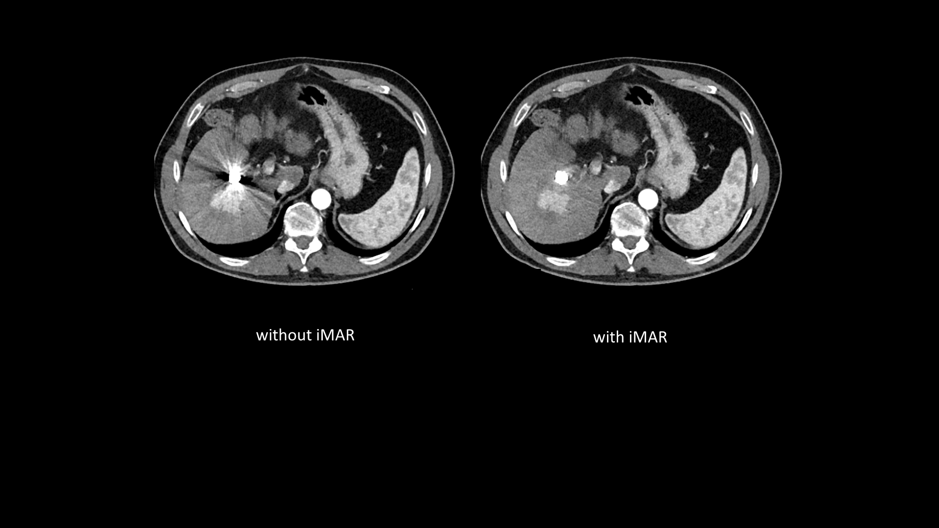Precision in oncological imaging - Siemens Healthineers Polska