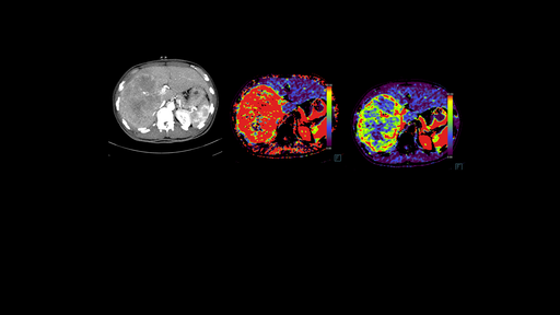 Precision in oncological imaging - Siemens Healthineers Polska