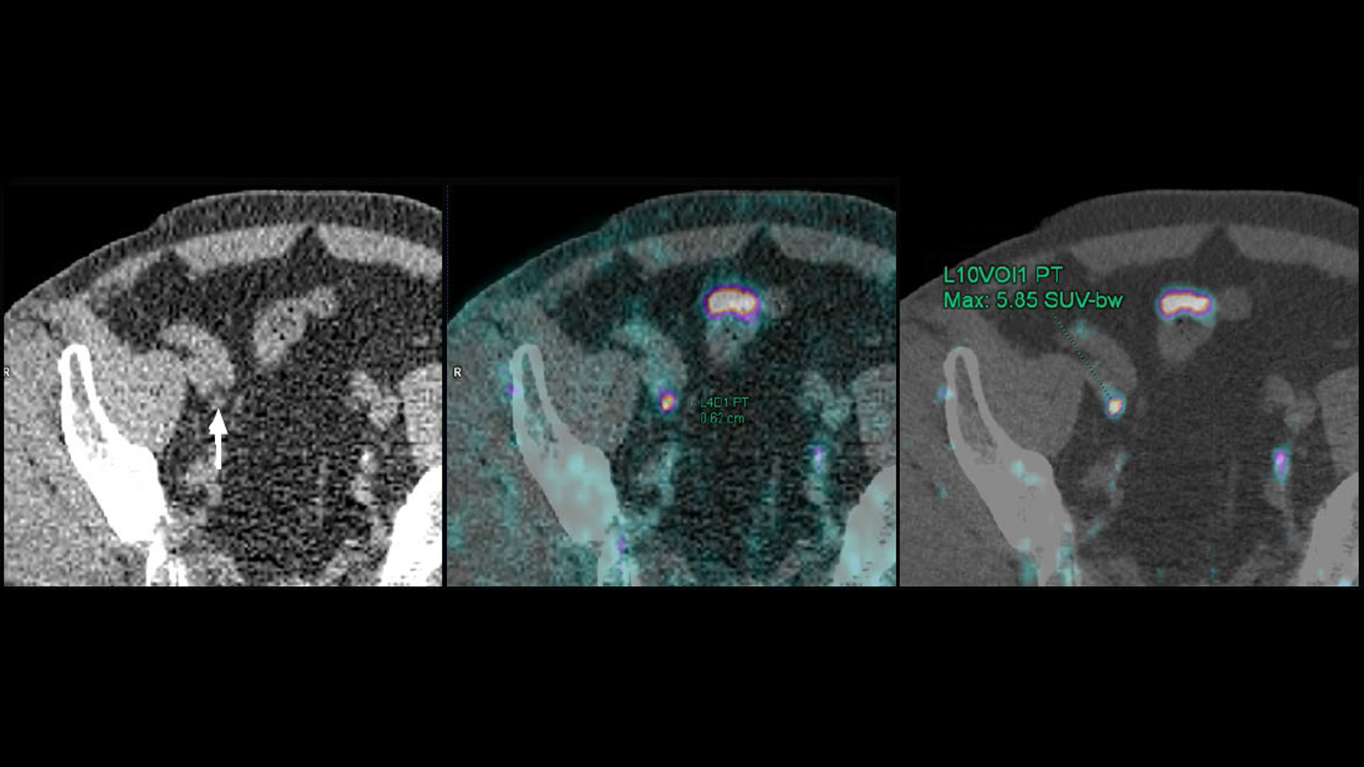Detection of solitary pelvic lymph node metastasis in a patient with ...