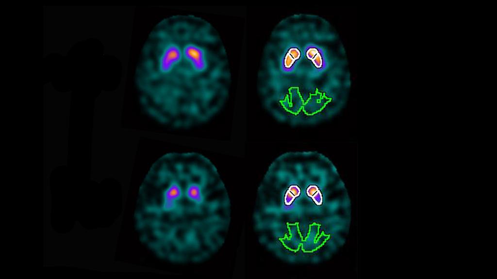 xSPECT Quant - Siemens Healthineers USA