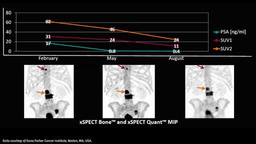 xSPECT Quant - Siemens Healthineers