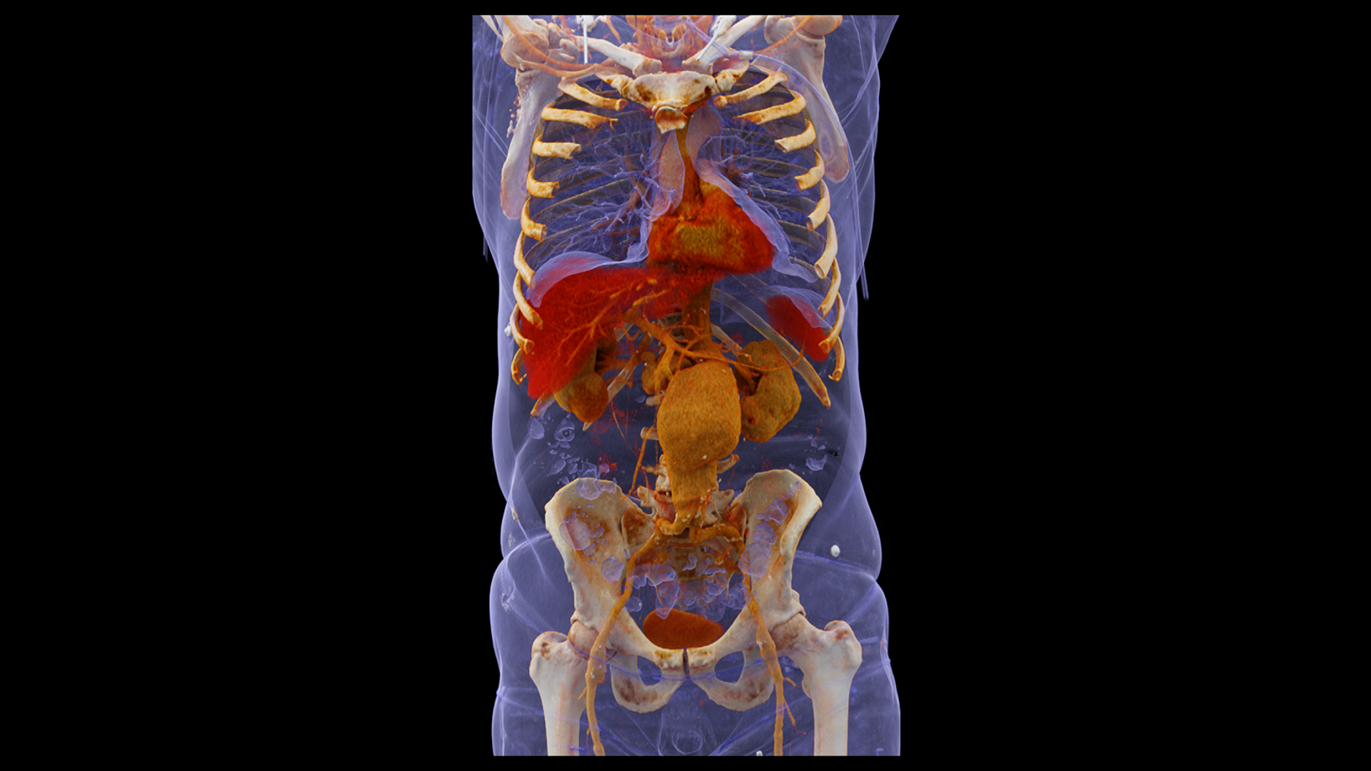 SOMATOM Force eco – CT Scanner - Siemens Healthineers