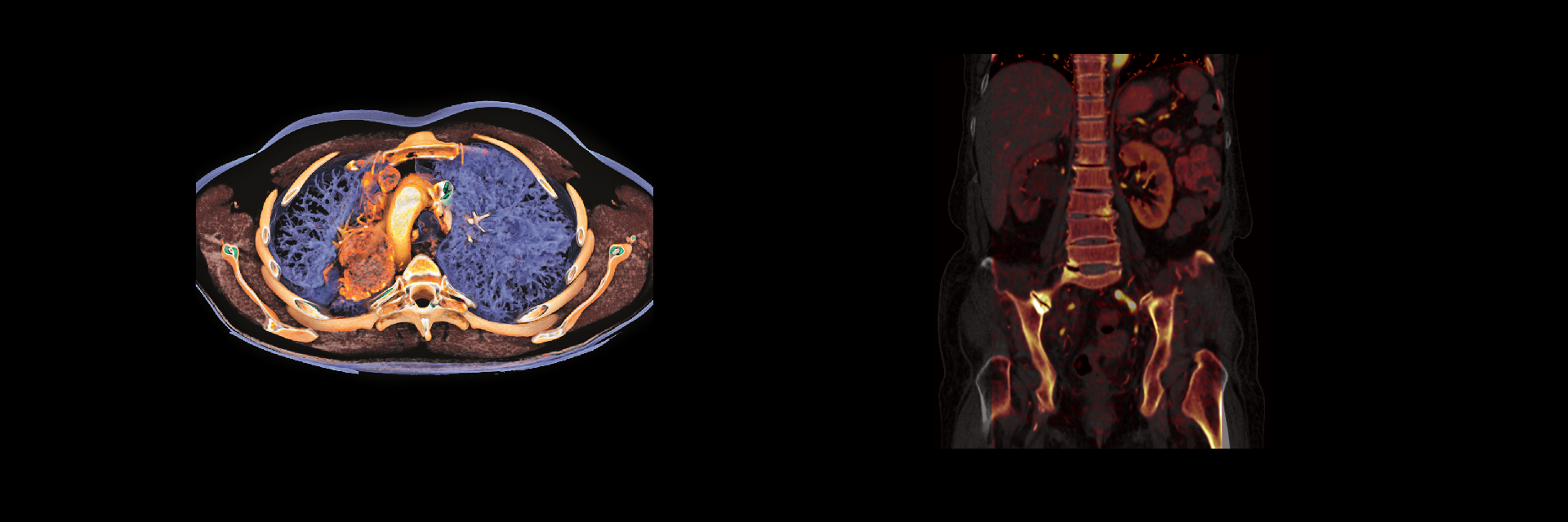 Precision in oncological imaging - Siemens Healthineers Polska