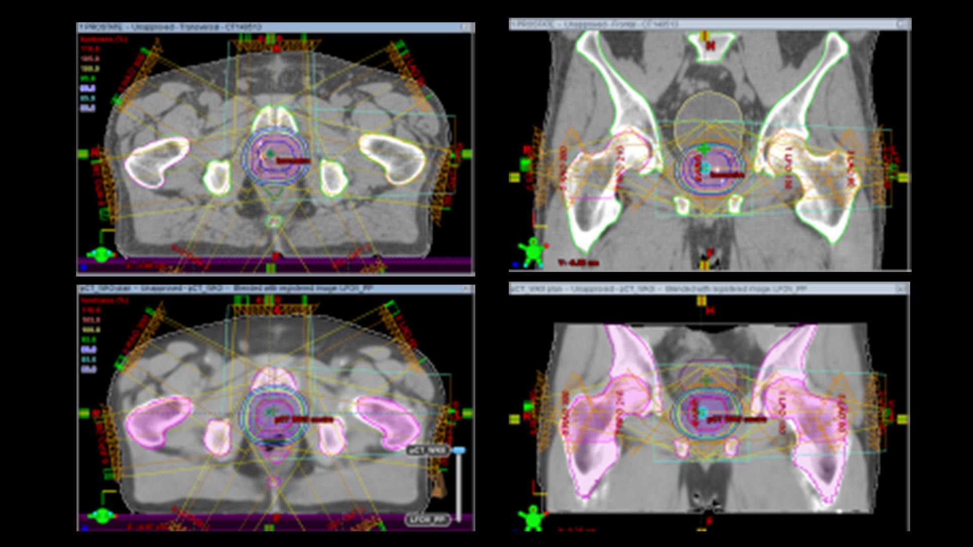 MR-only radiotherapy planning with Synthetic CT - Siemens Healthineers