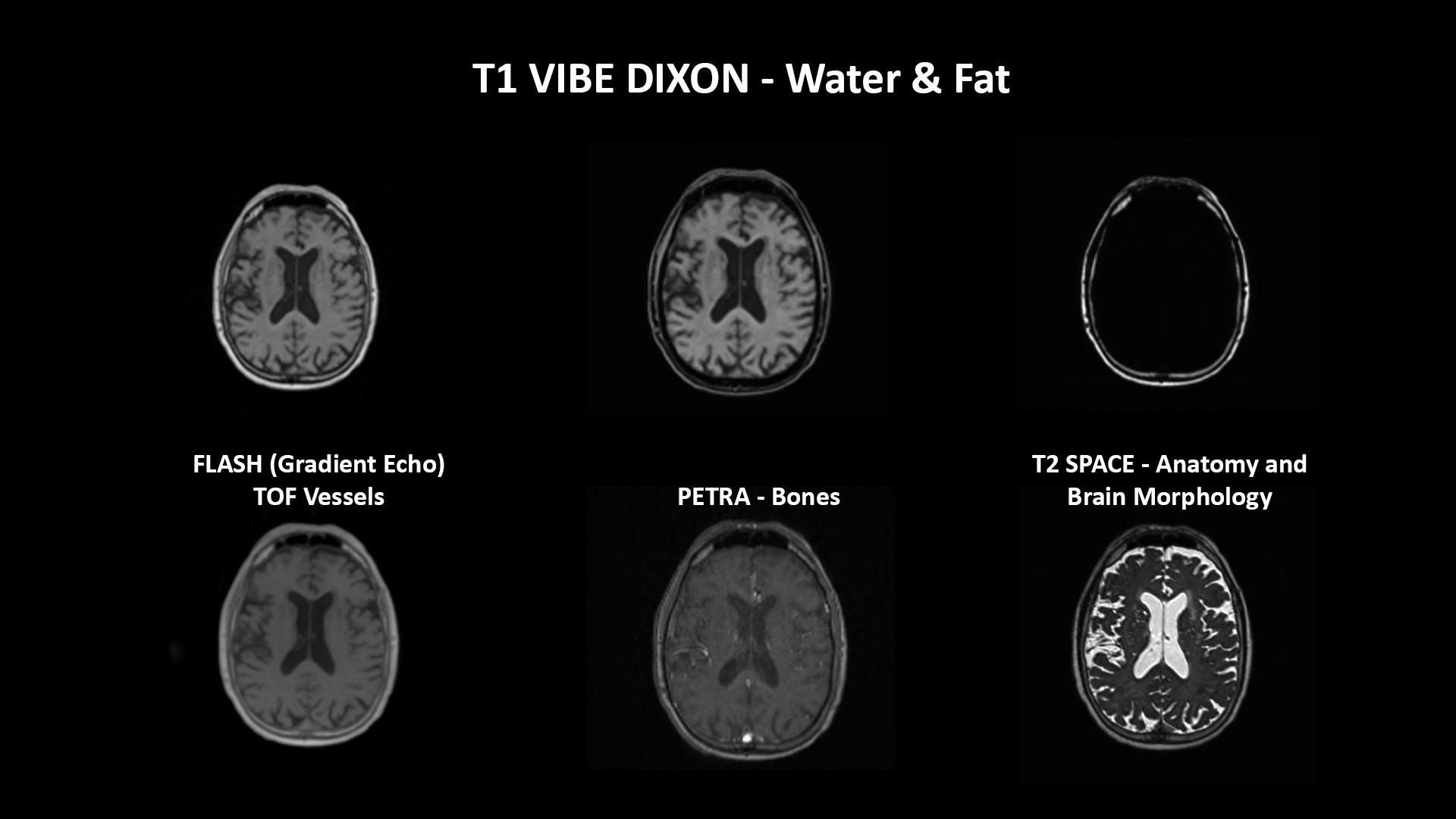 MR-only radiotherapy planning with Synthetic CT