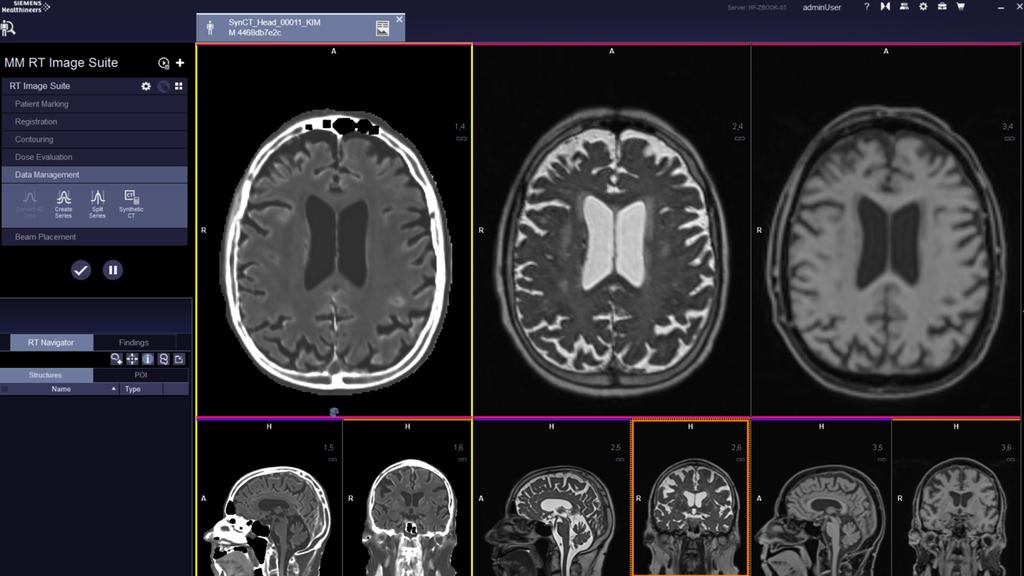MR-only radiotherapy planning with Synthetic CT