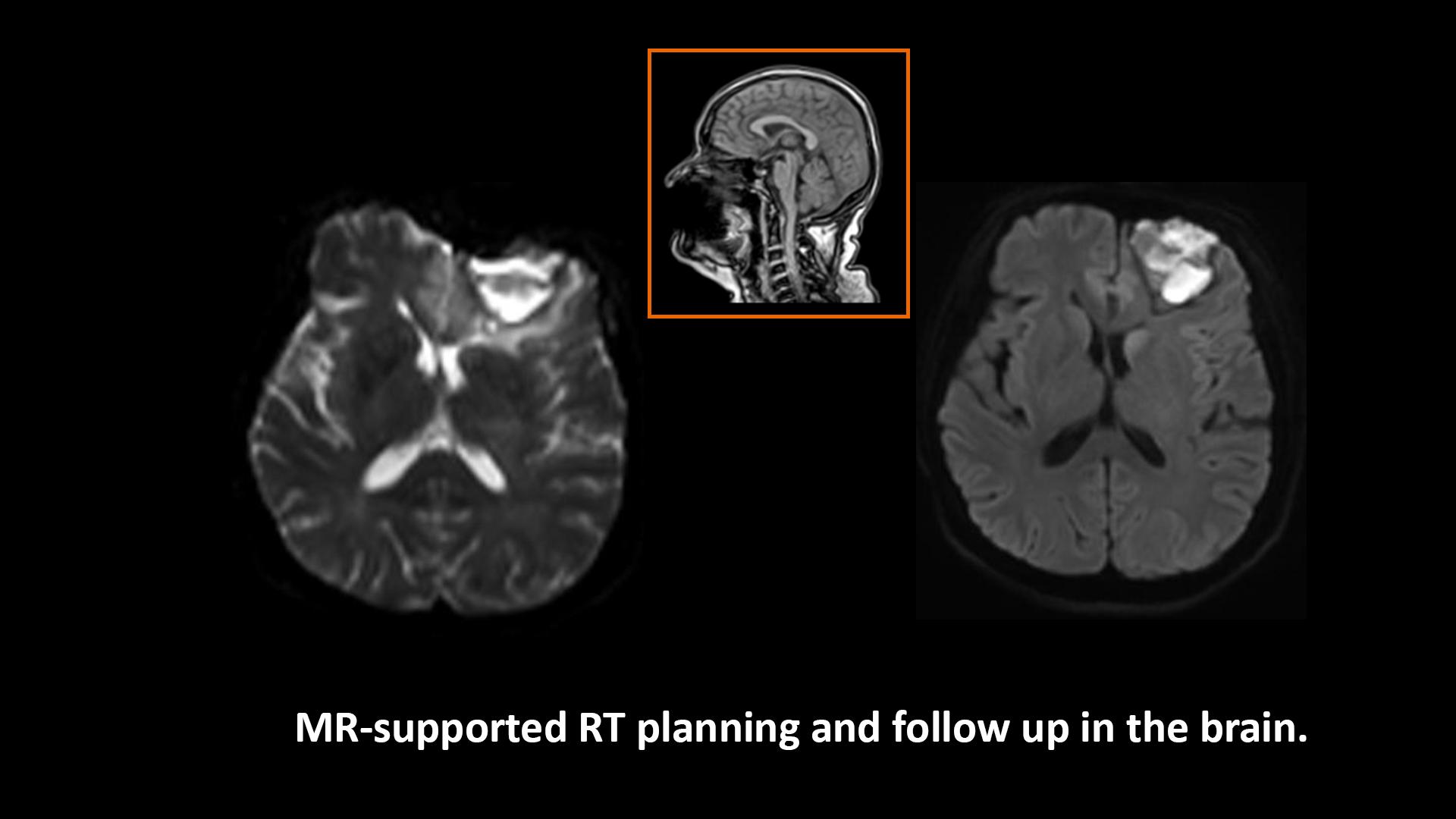 MR-only radiotherapy planning with Synthetic CT Siemens Healthineers Italia