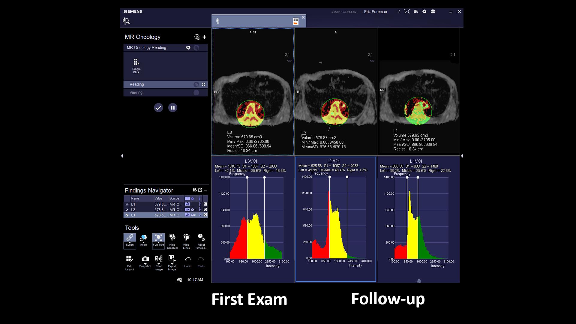 MR-only radiotherapy planning with Synthetic CT - Siemens Healthineers