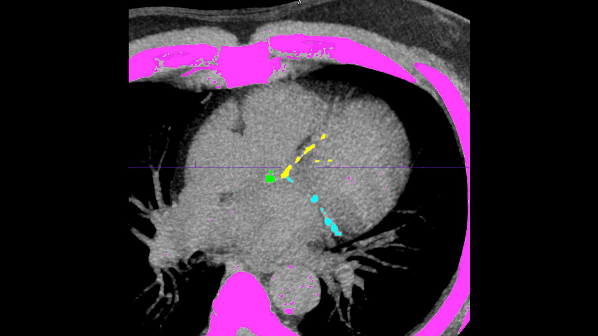 Time to Rethink the Calcium Scoring Workflow