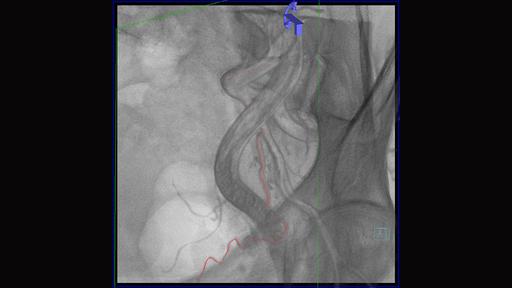 Prostatic Artery Embolization is Here to Stay