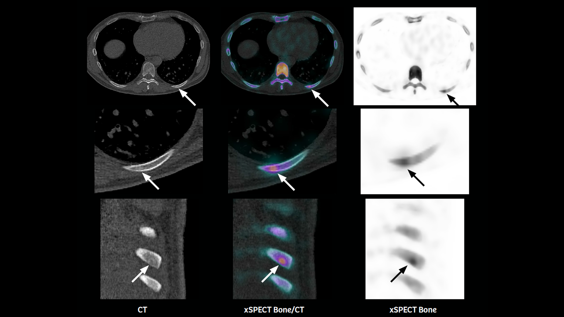Differentiation of a rib benign lesion from a metastasis using xSPECT ...