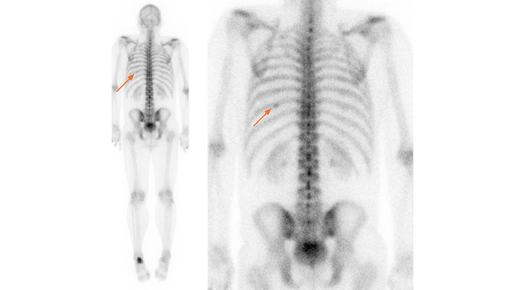 Differentiation of a rib benign lesion from a metastasis using xSPECT ...