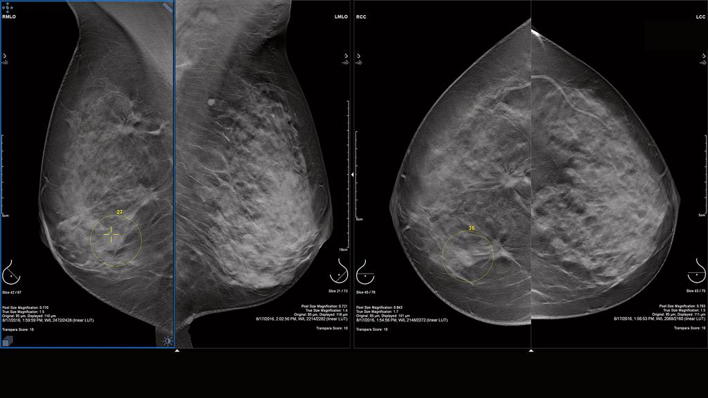 syngo.Breast Care - Siemens Healthineers USA