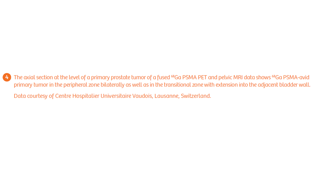 Detection of bladder invasion and pelvic lymph node metastases in a ...