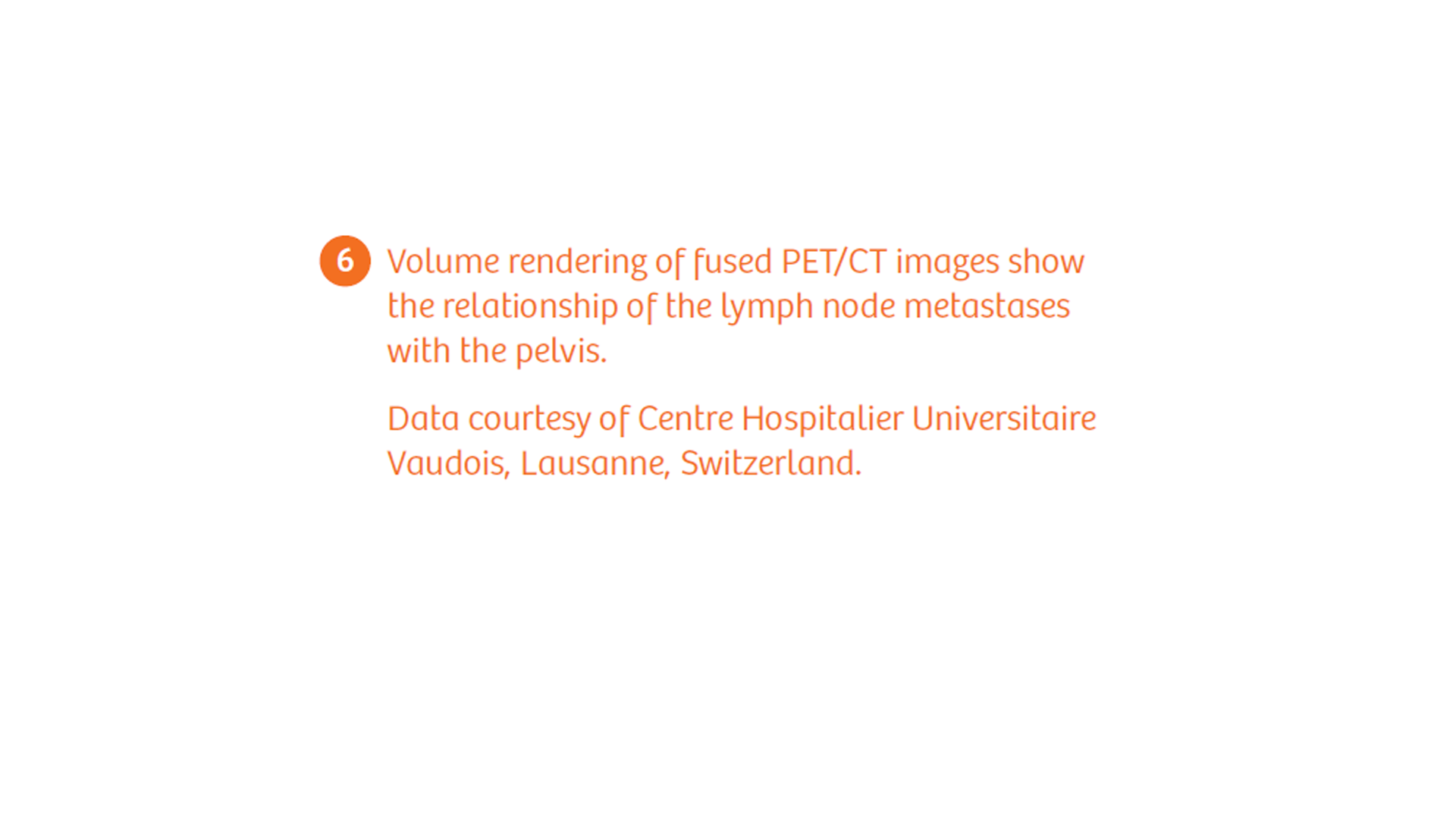Detection Of Bladder Invasion And Pelvic Lymph Node Metastases In A