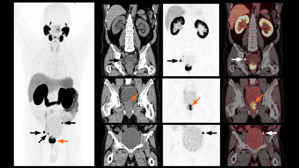 SPECT/CT overcomes breast-attenuation artifact for improved specificity ...