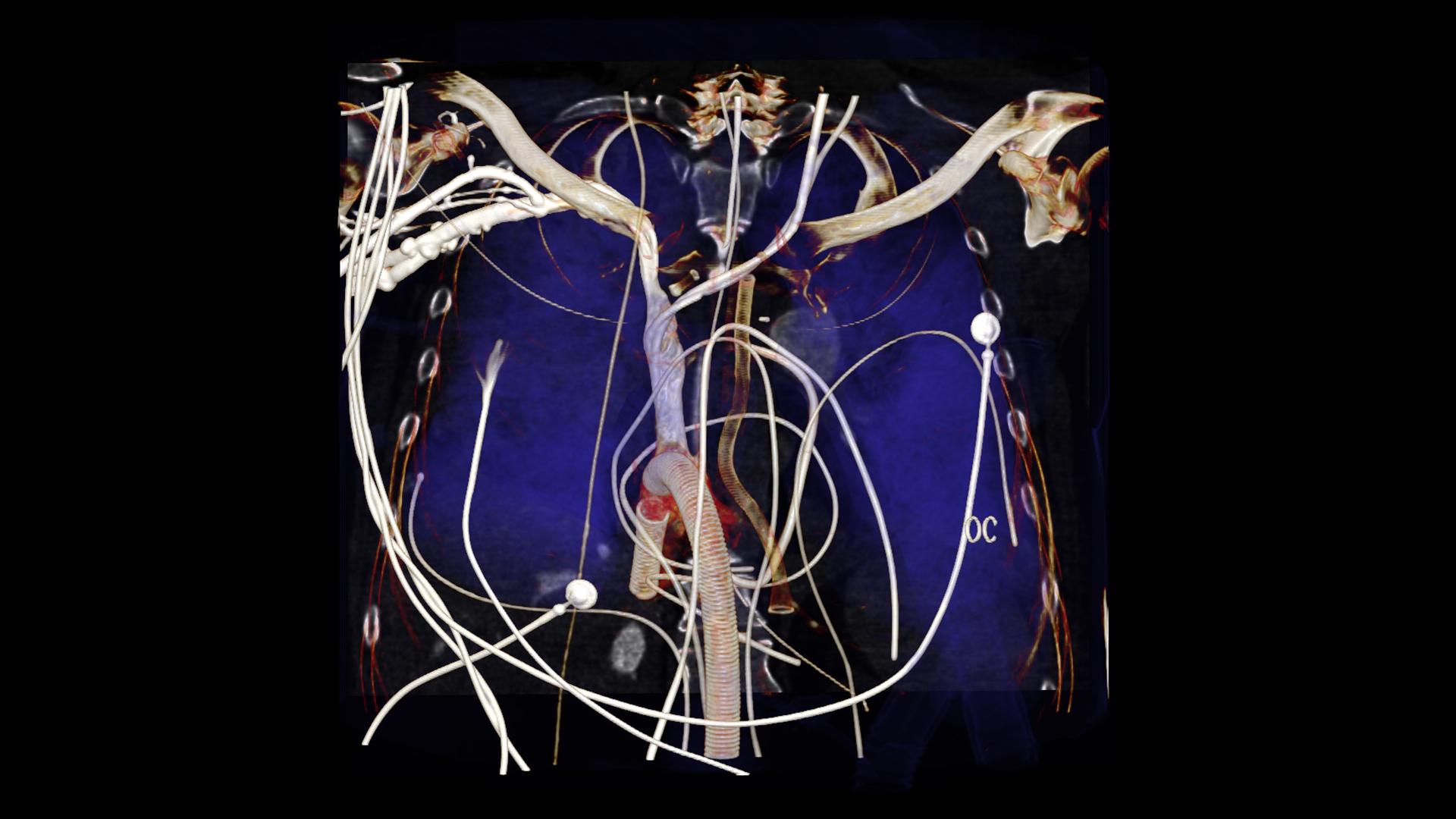 Pulmonary CTA in the Setting of Venoarterial Extracorporeal Membrane ...