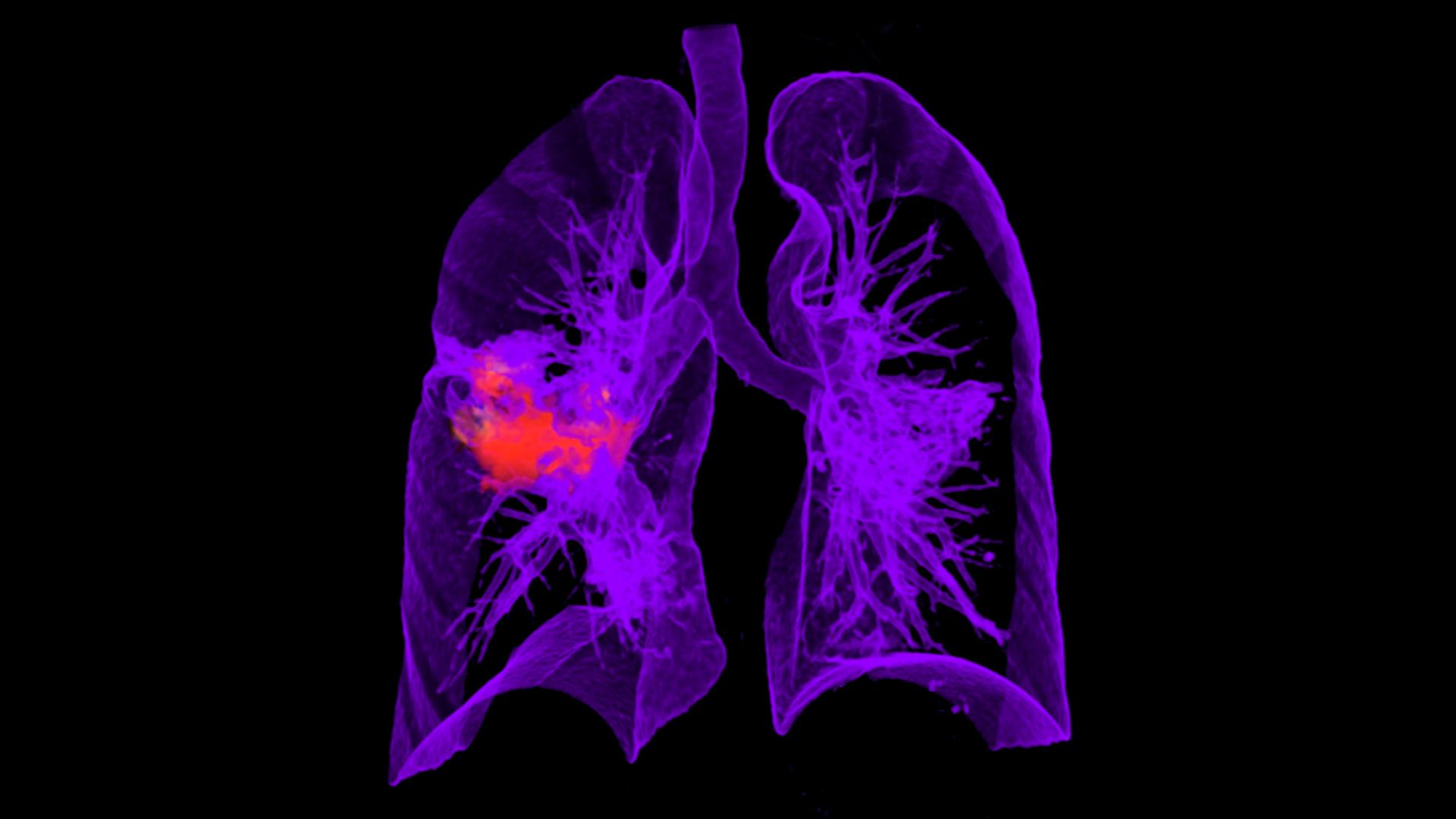 Ultra-low Dose & Ultra-fast Scan in a Patient with Dyspnea - Siemens ...