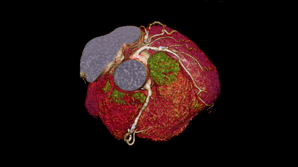 Low-Dose Coronary CT Angiography with 0.37 mSv & 35 mL Contrast Agent ...
