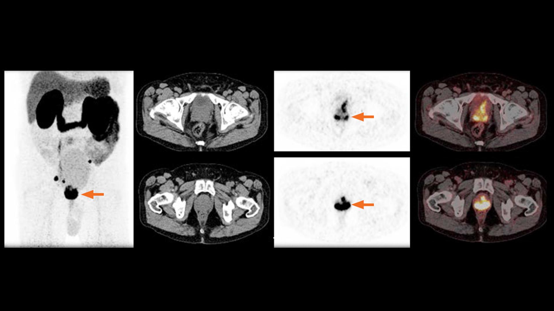 Detection of bladder invasion and pelvic lymph node metastases in a ...